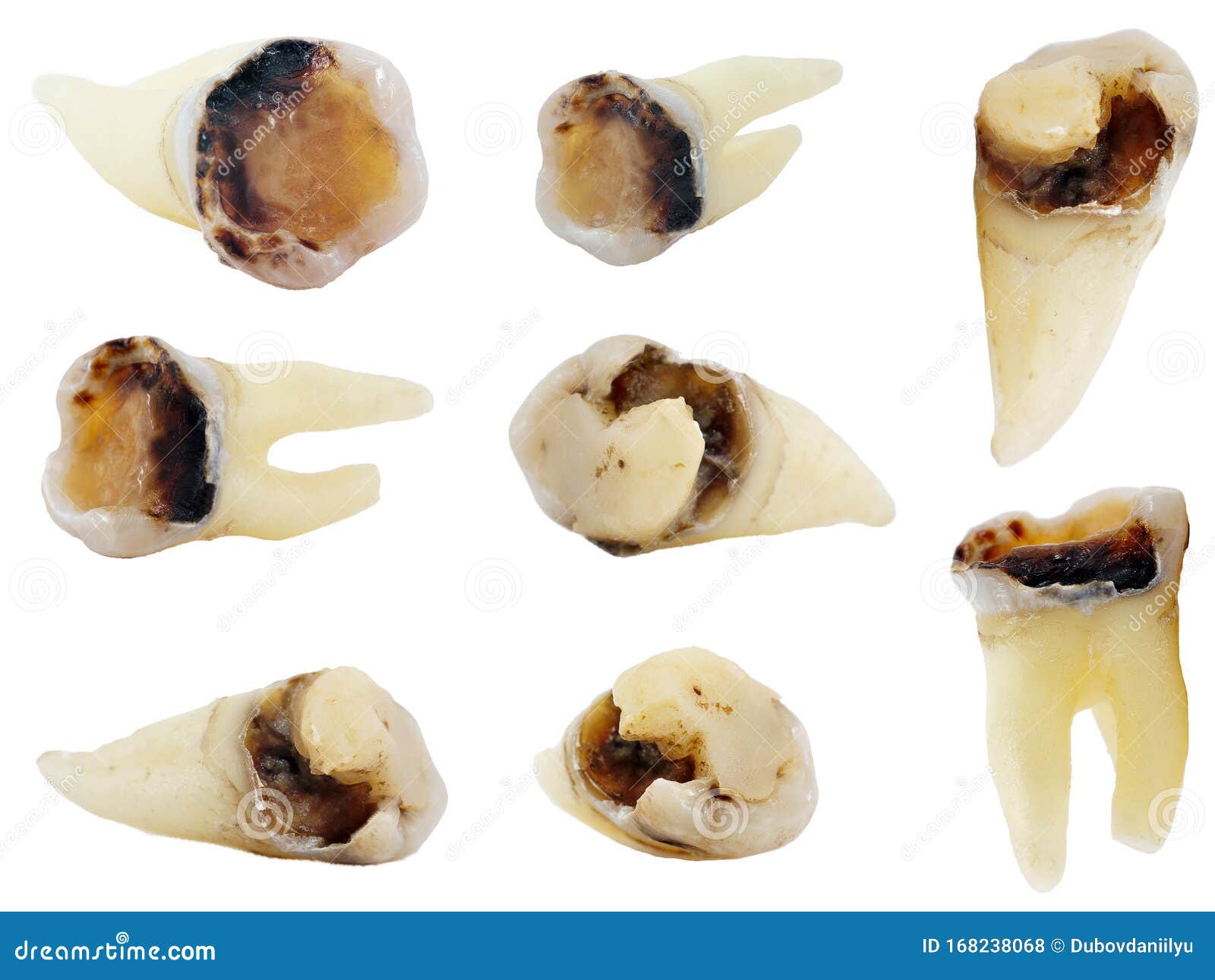 Extracted carious teeth stock photo. Image of mouth - 168238068