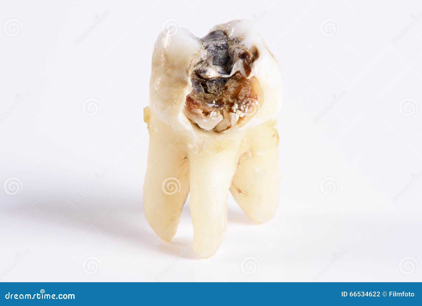 Extracted Molar Teeth With Caries Decay And Filling With Tooth Paste ...