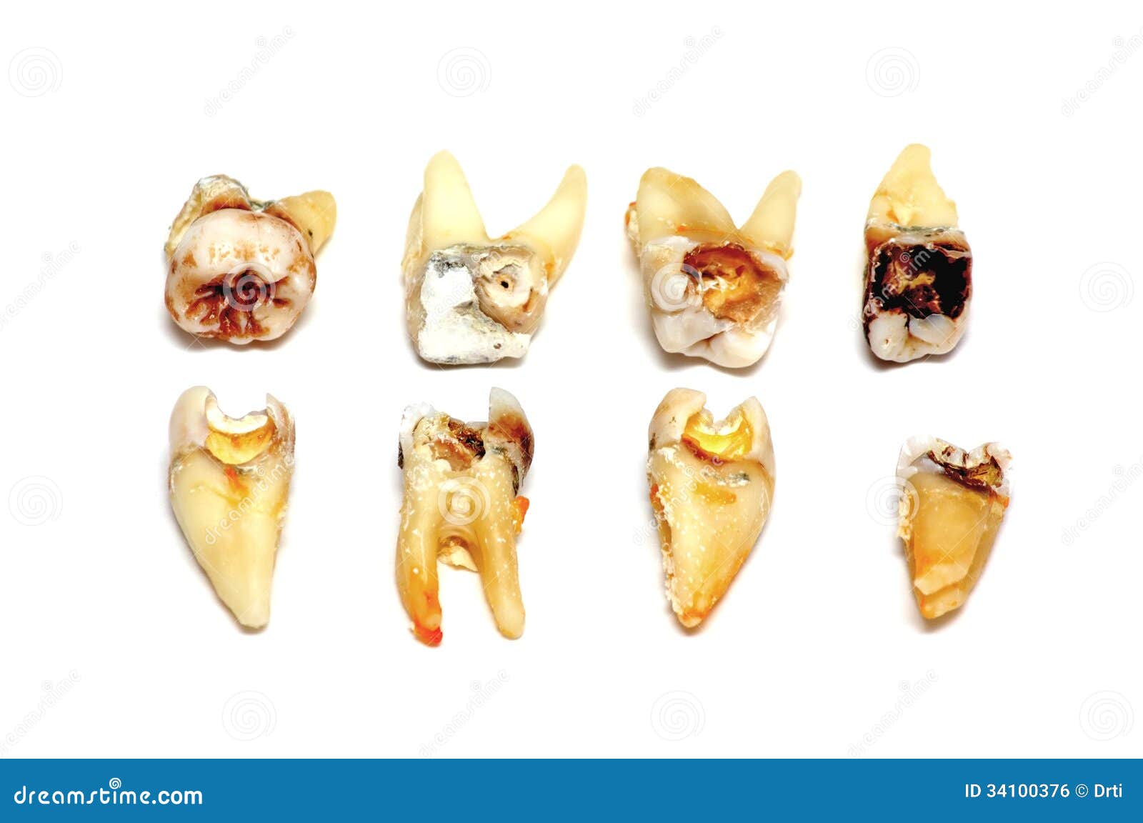 Extracted Teeth on a White Background Stock Photo - Image of anatomy ...