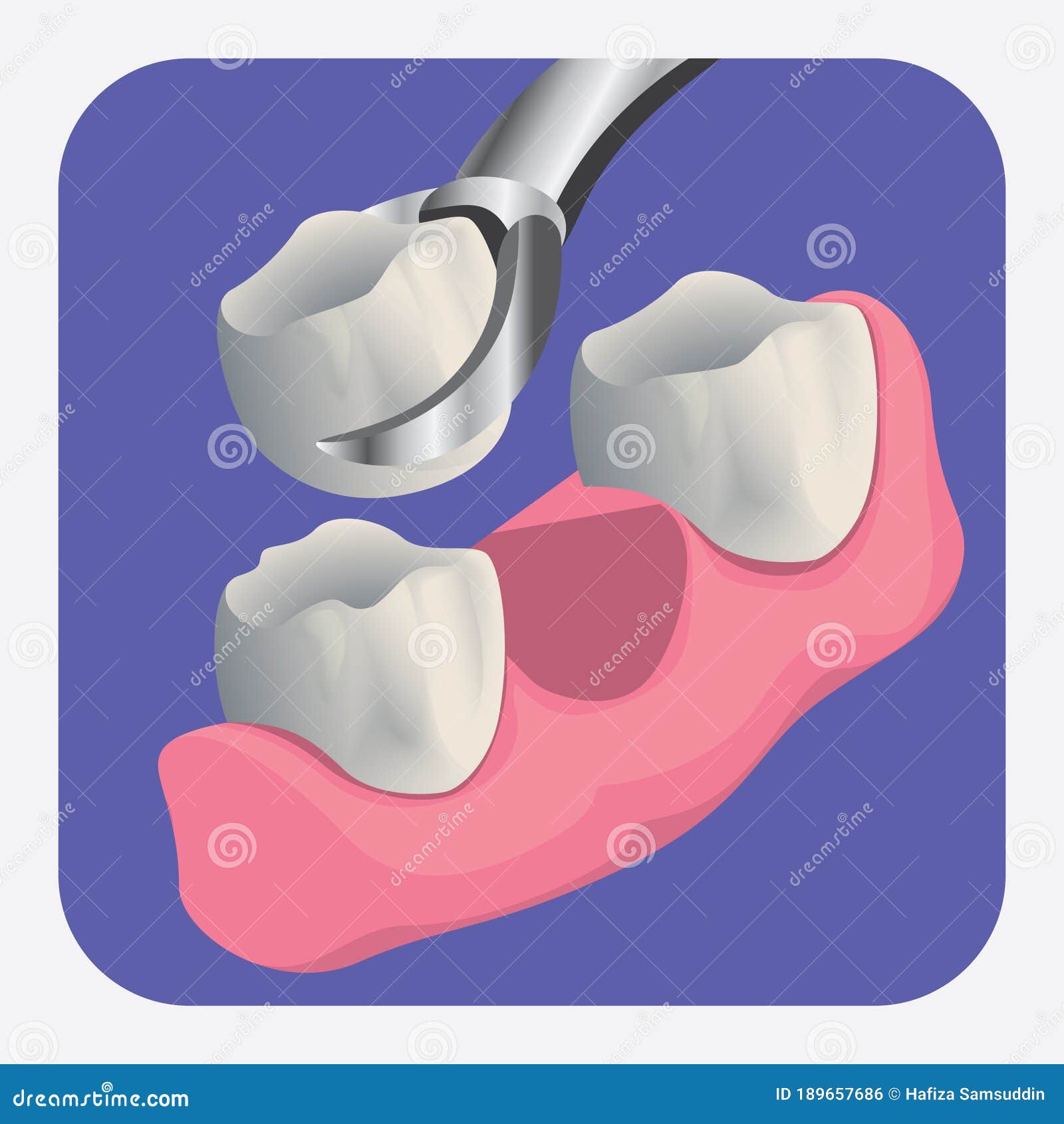 Extracted Tooth. Vector Illustration Decorative Design Stock Vector ...