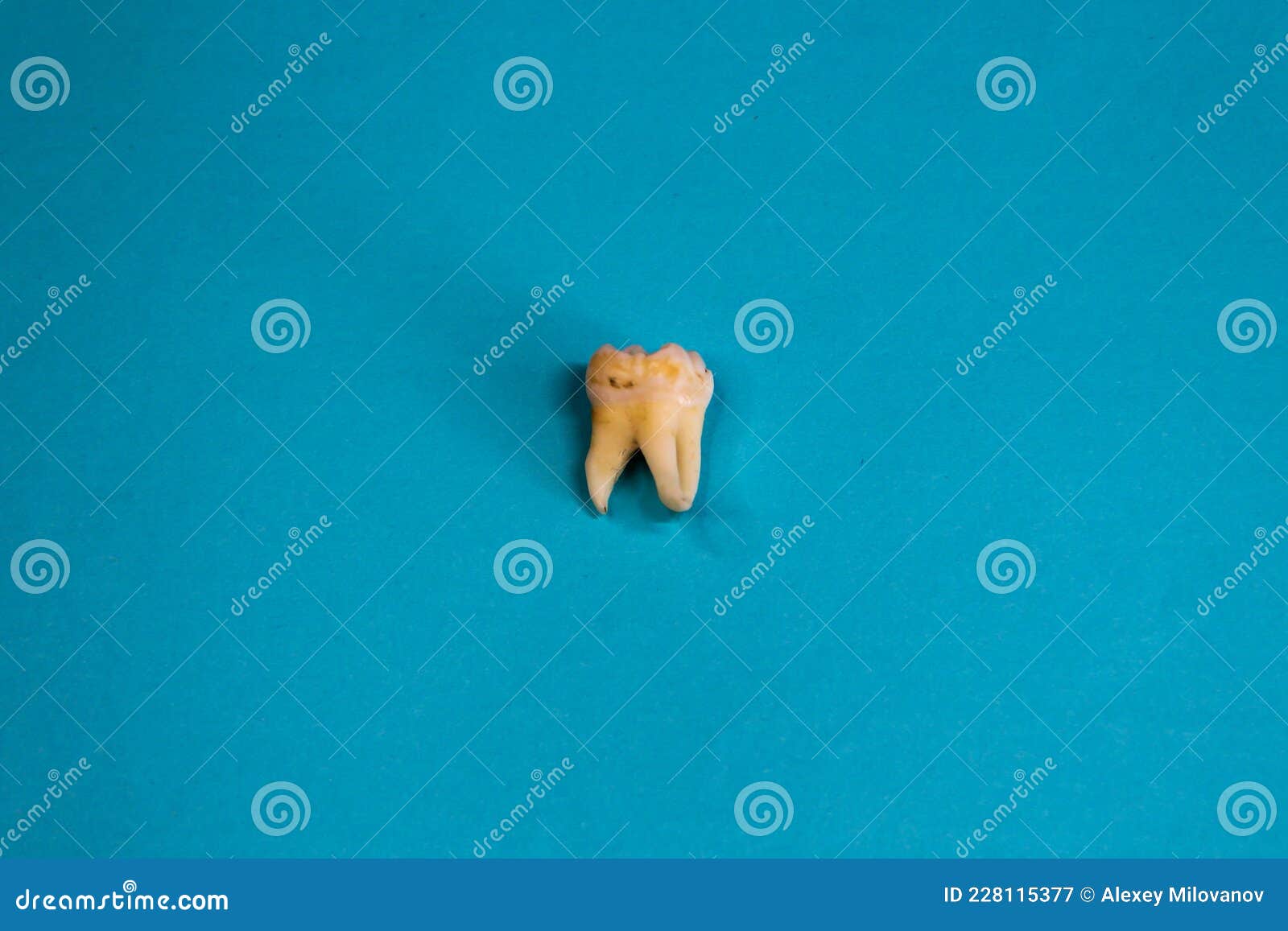 Extracted Wisdom Teeth On A Medical Tray Table With Dental Tools And ...