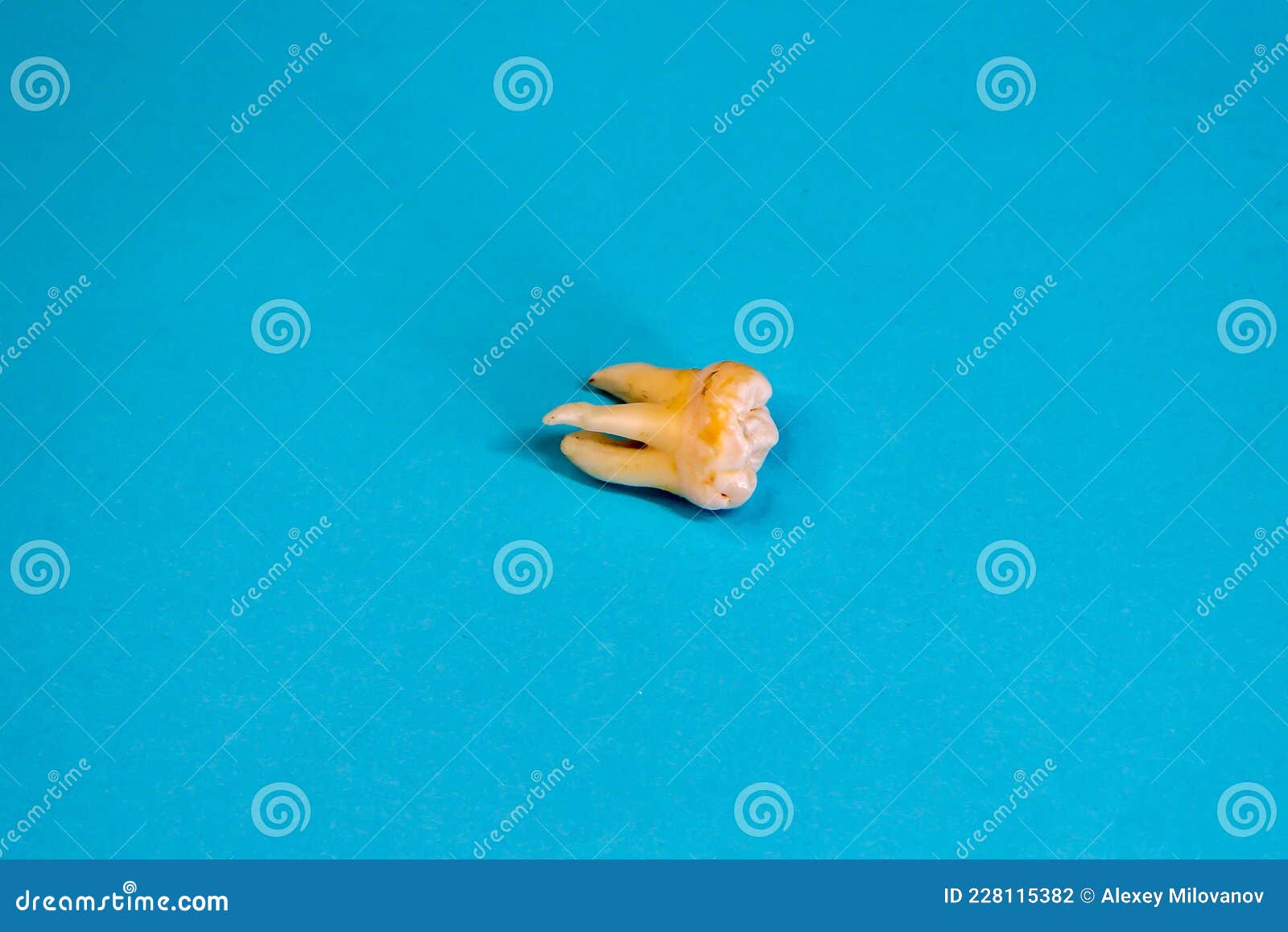 Extracted Wisdom Teeth On A Medical Tray Table With Dental Tools And ...