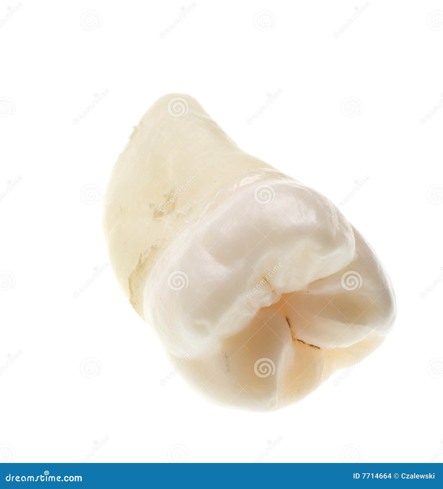Wisdom Tooth With Cavity Royalty-Free Stock Photography | CartoonDealer ...