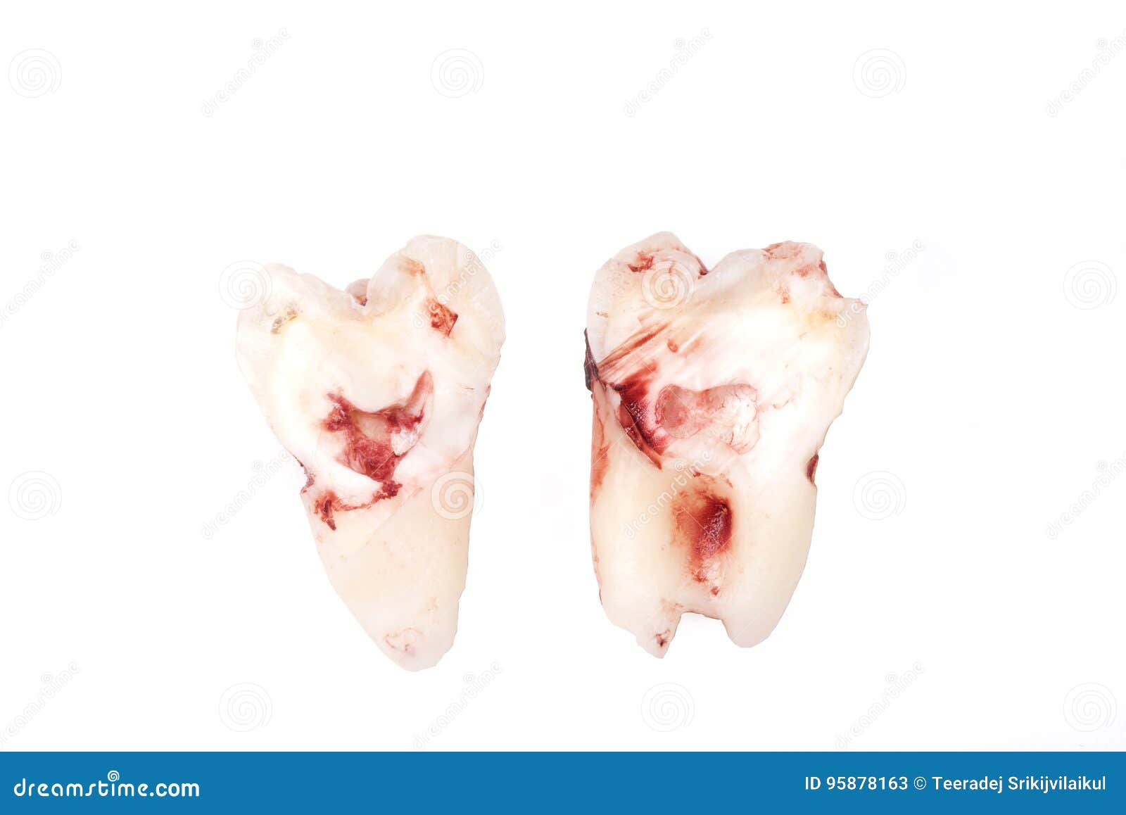 Extracted Wisdom Tooth Split in a Half Stock Image - Image of isolated ...