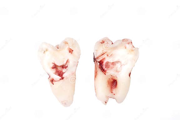 Extracted Wisdom Tooth Split in a Half Stock Image - Image of isolated ...