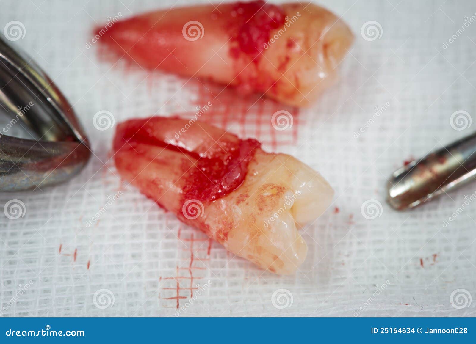 Extraction of Tooth with Dental Tools. Stock Photo - Image of care ...