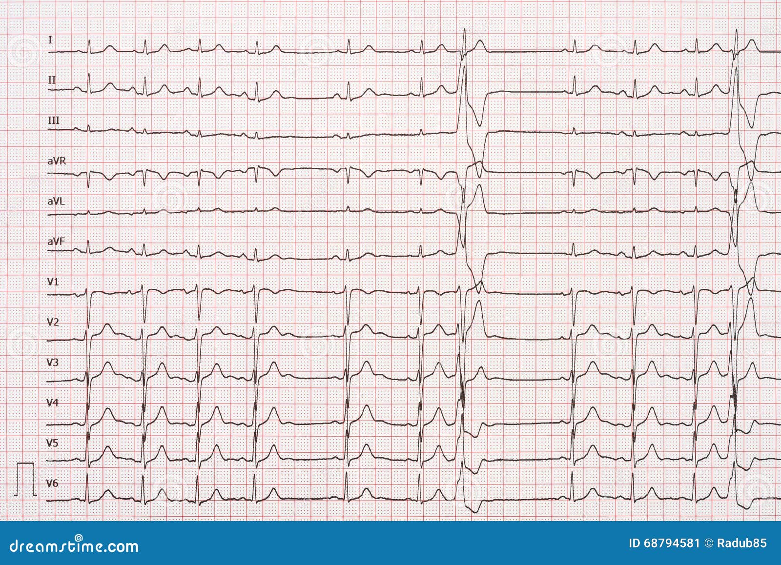 Extrasystole on 12 Lead Electrocardiogram Paper Stock Image - Image of ...