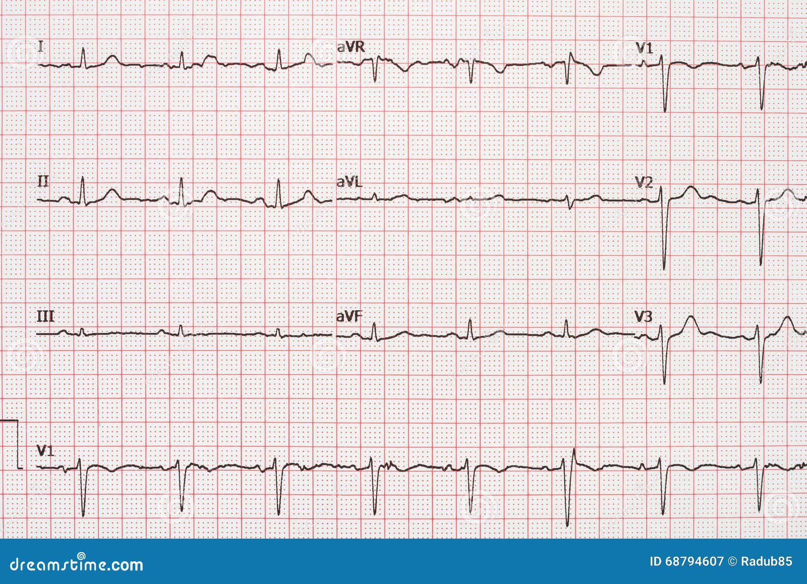 Extrasystole on 12 Lead Electrocardiogram Paper Stock Image - Image of ...