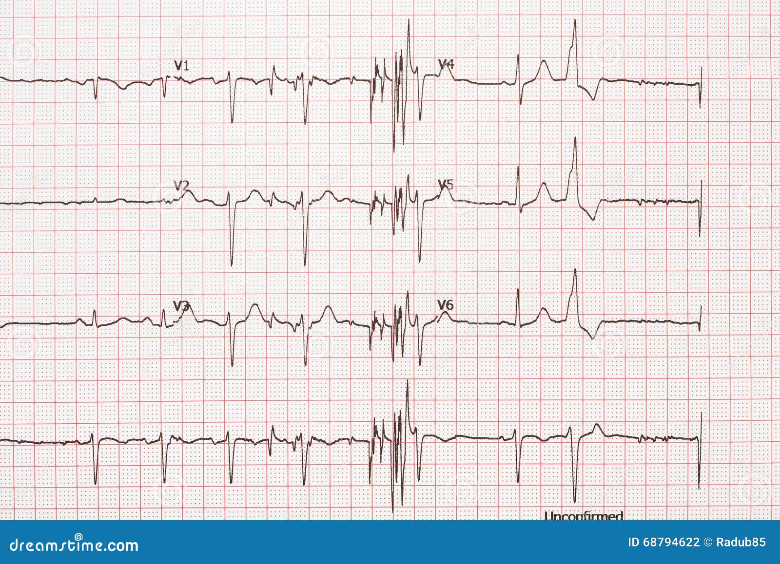 Extrasystole on 12 Lead Electrocardiogram Paper Stock Photo - Image of ...
