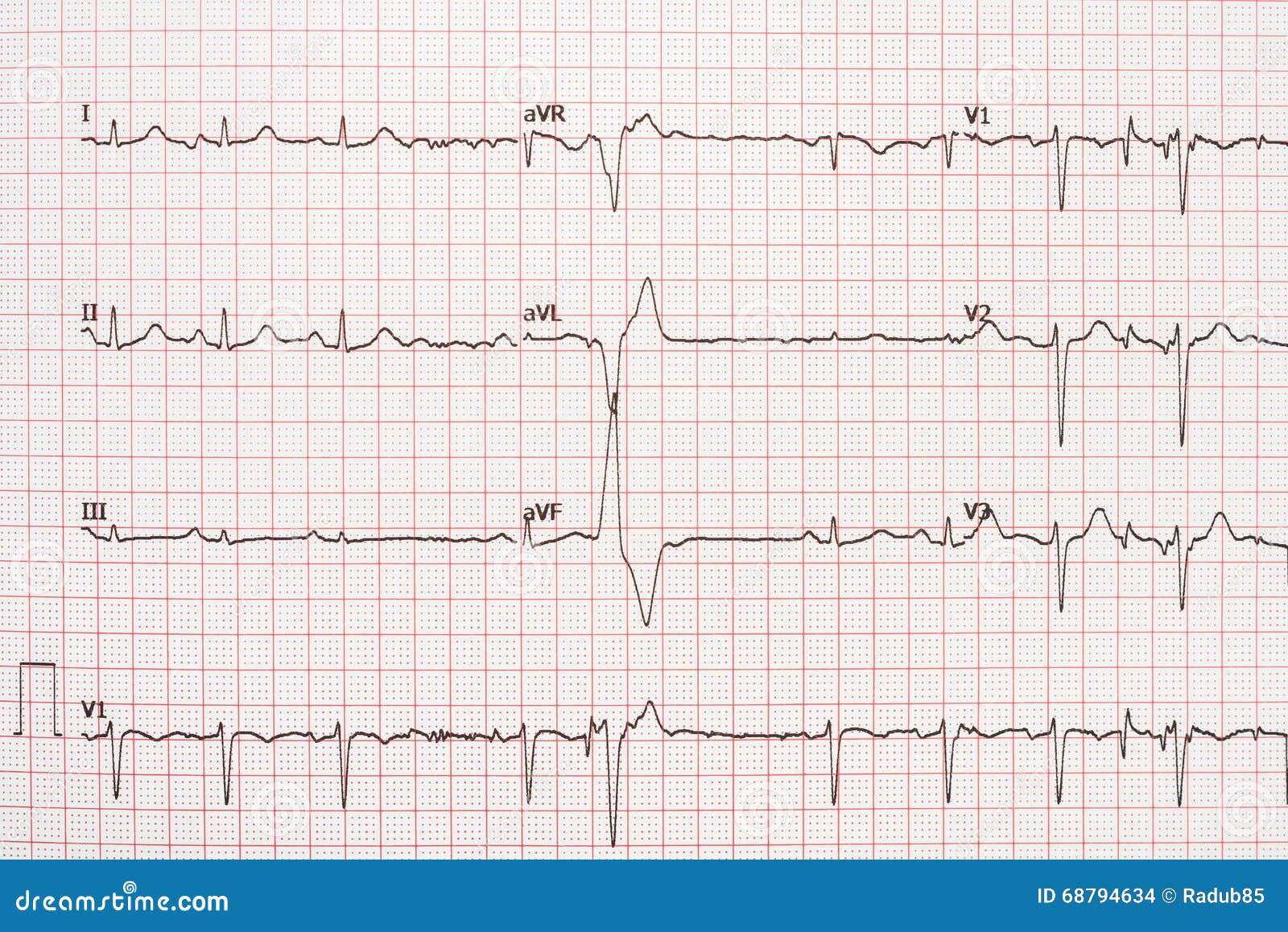 Extrasystoles On Electrocardiogram Stock Photography | CartoonDealer ...