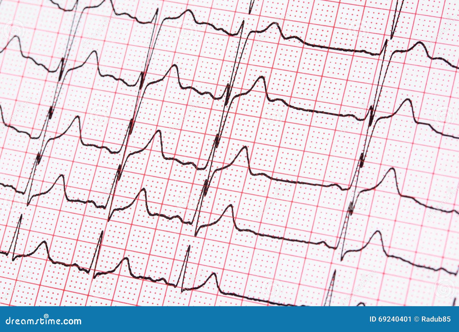 Extrasystoles on Electrocardiogram Stock Image - Image of ...