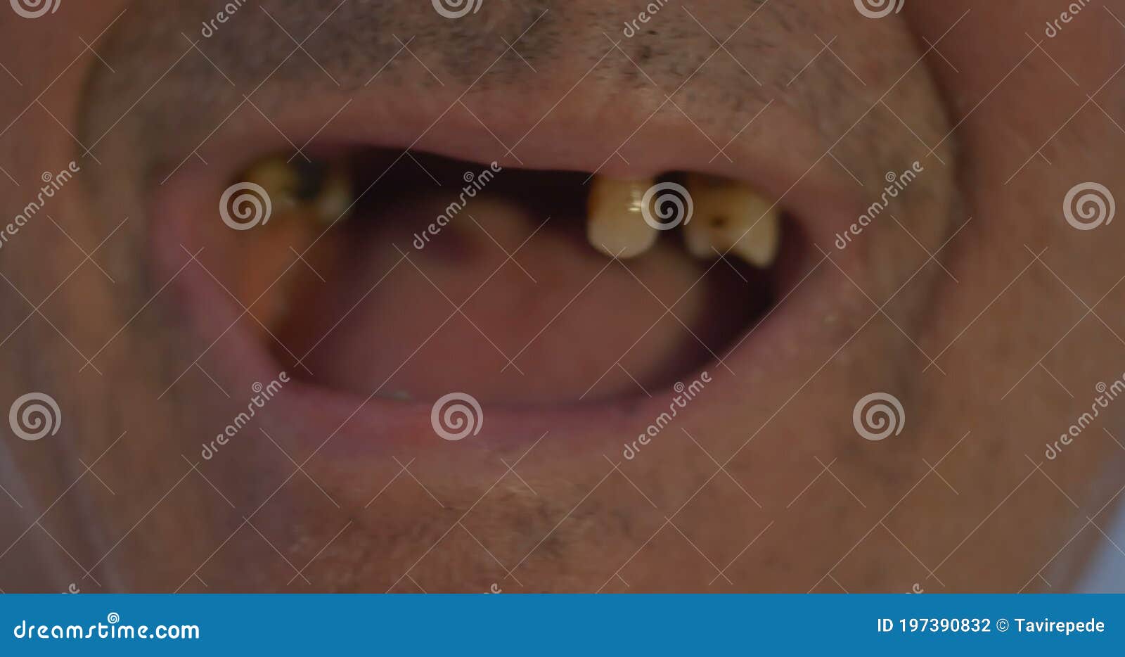 Extreme Bad Denture stock footage. Video of caries, amalgam - 197390832