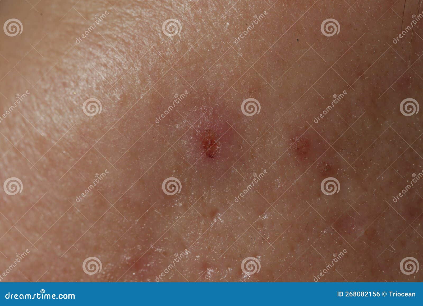 Problematic Human Skin With Pimples Royalty-Free Stock Photography ...