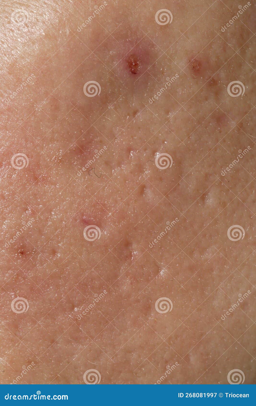 Problematic Human Skin With Pimples Royalty-Free Stock Photography ...