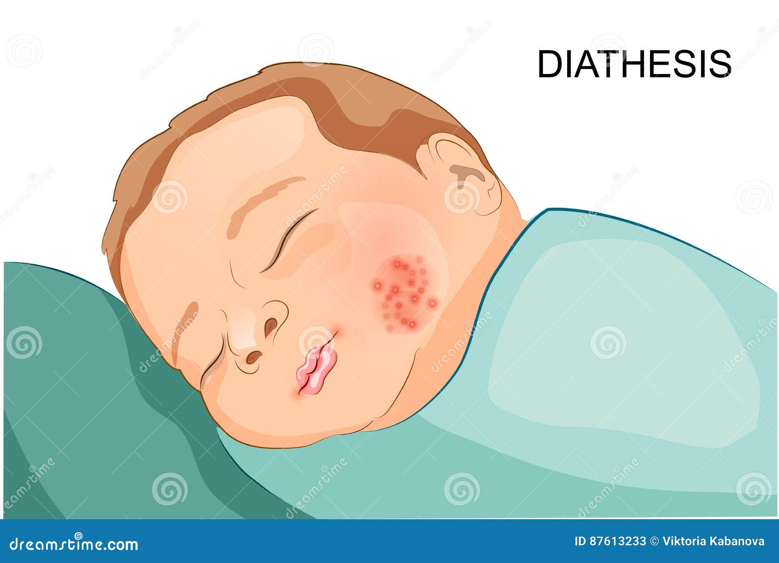 Exudative Diathesis in Toddler Stock Vector - Illustration of medicine ...