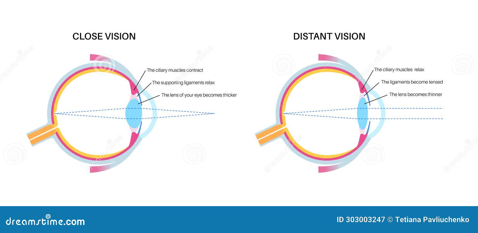 Eye accommodation poster stock vector. Illustration of tensed - 303003247