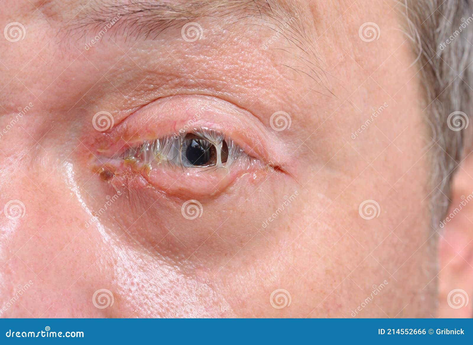 An Eye with Bacterial Purulence Conjunctivitis, Also Known As Pink Eye ...