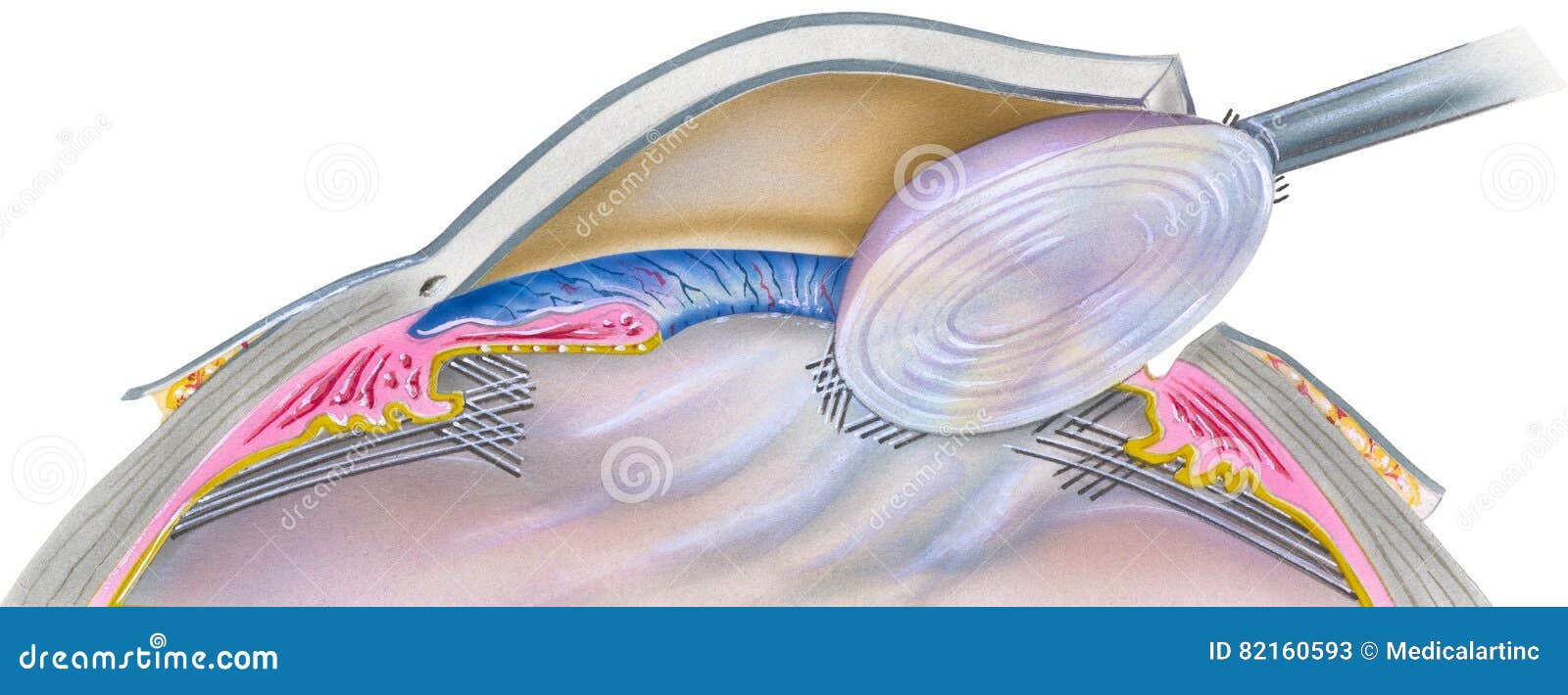 Eye - Cataract Surgery Step 1 Stock Illustration - Illustration of ...