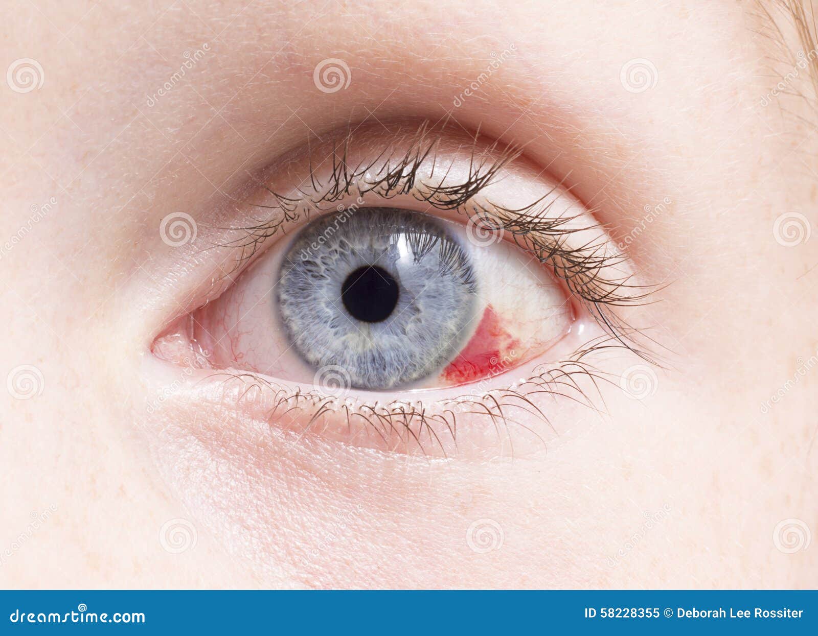 Eye stock image. Image of conjunctiva, sclera, hemorrhage - 58228355