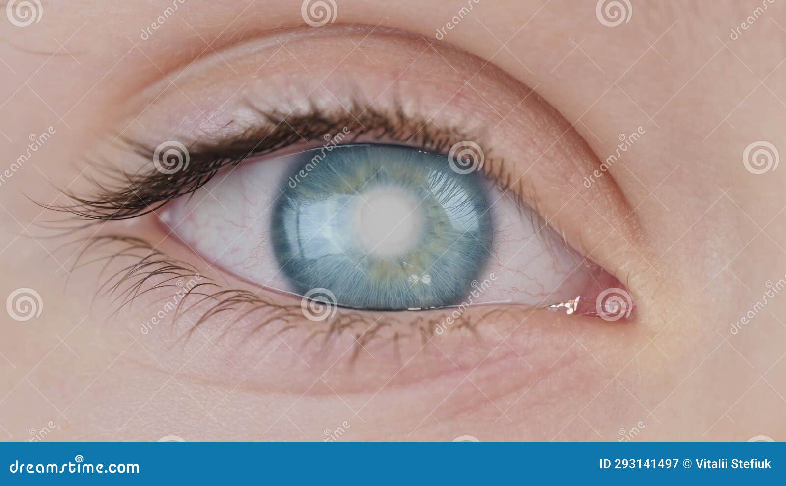 Eye corneal opacity stock video. Video of optic, iris - 293141497