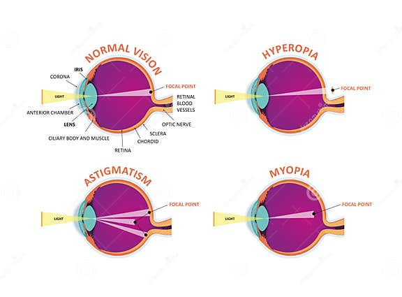 Eye Defects. Normal Vision, Hyperopia, Myopia. Stock Vector ...