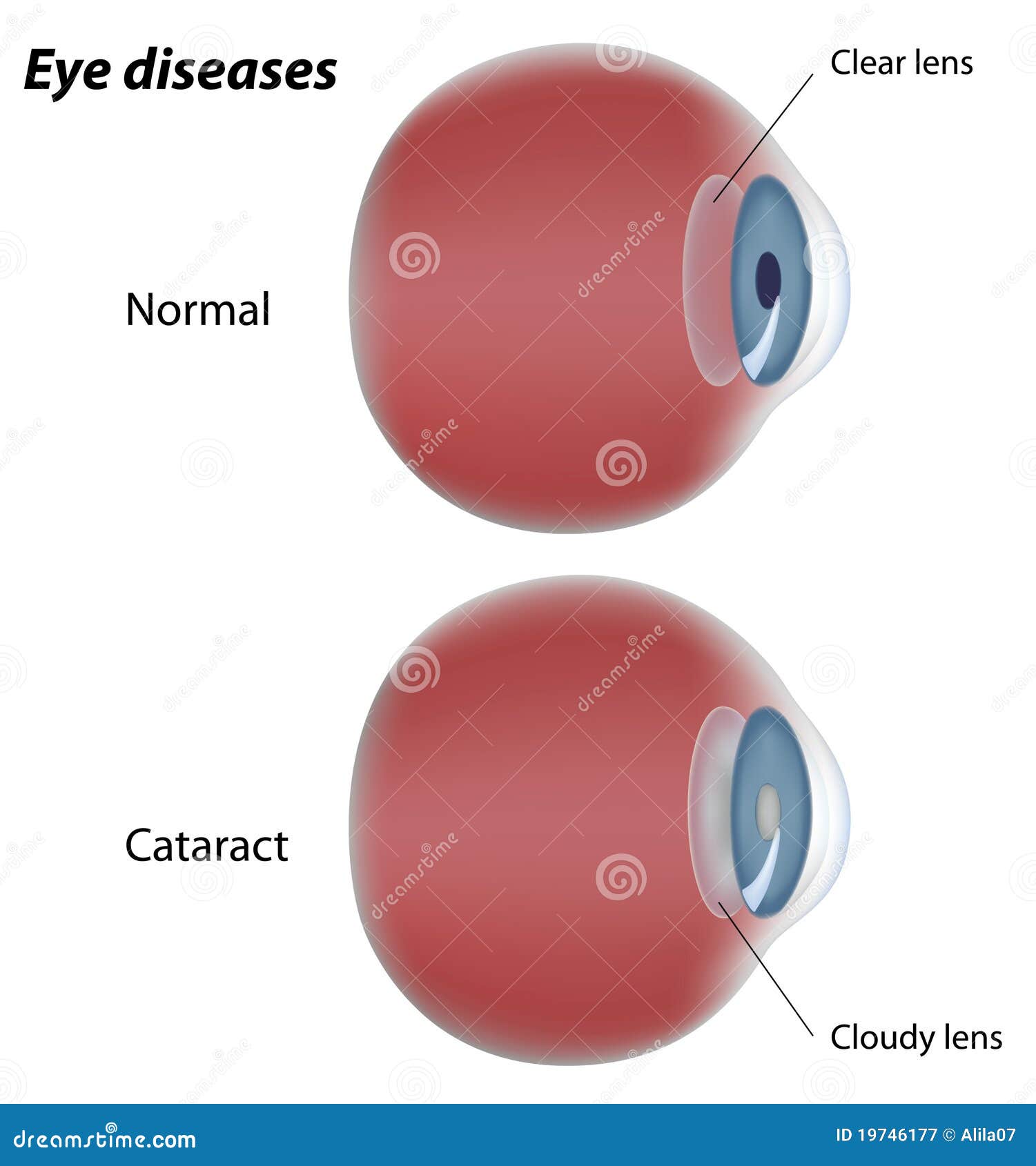 Eye Disease - Cataract Royalty Free Stock Photography - Image: 19746177