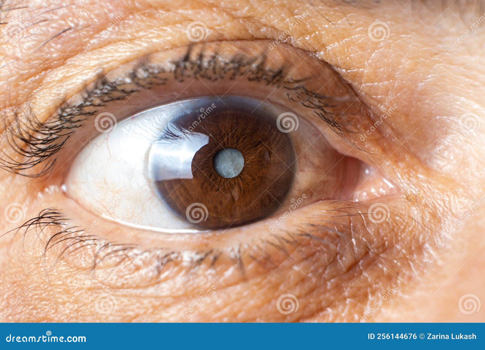 Eye of an Elderly Man with Cataracts, Clouding of the Lens, Macro ...