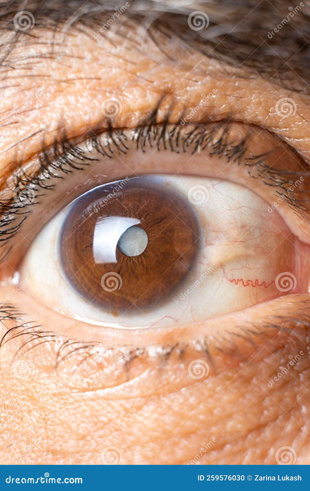 Eye of an Elderly Man with Cataracts, Clouding of the Lens, Macro ...