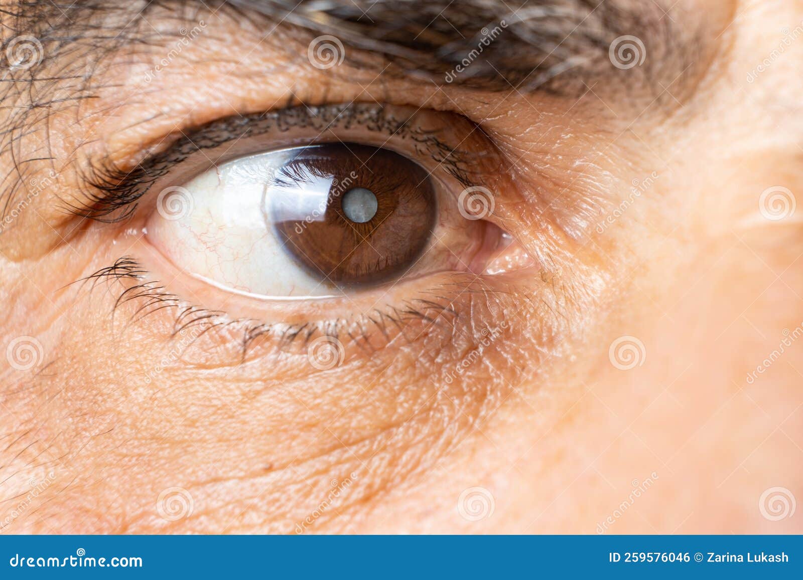 Eye of an Elderly Man with Cataracts, Clouding of the Lens, Macro ...