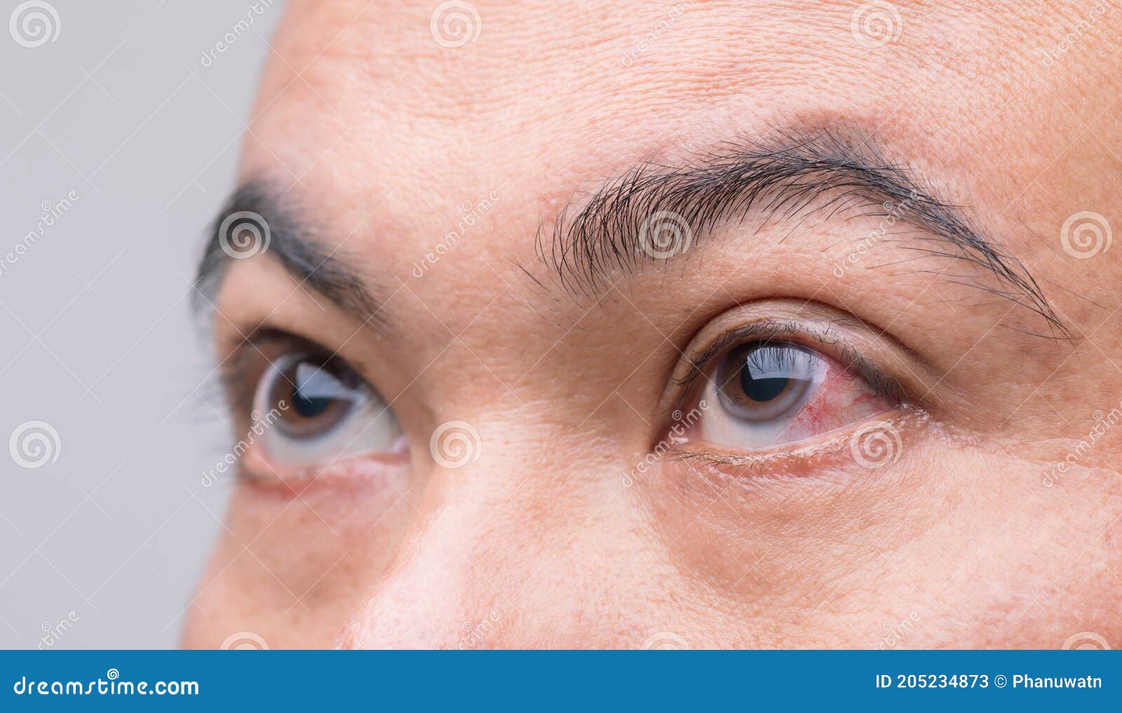 Eye Irritation Concept : Red Eye of Man, Conjunctivitis Eye or after ...
