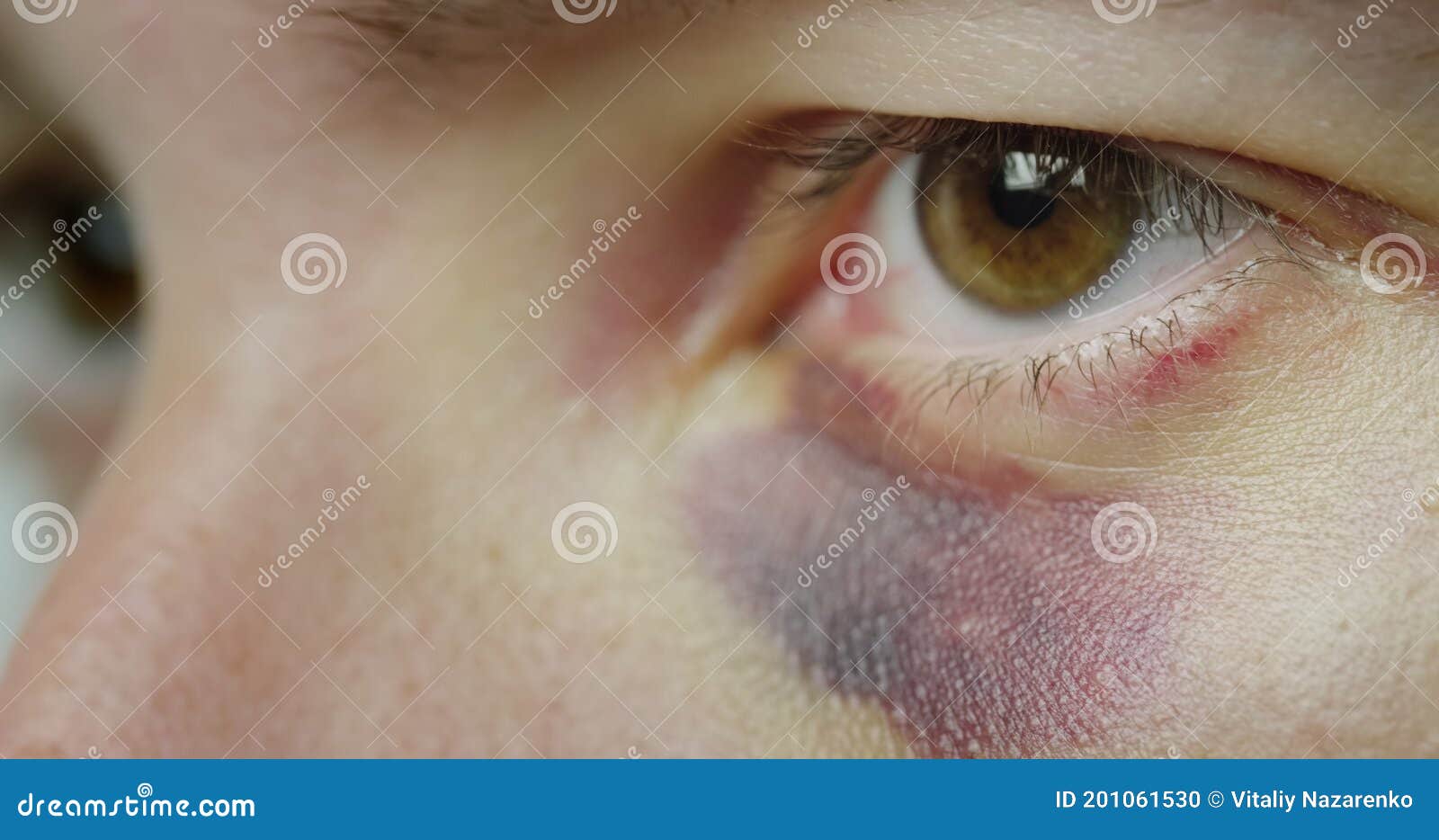 The Eye of a Man with a Bruise and Abrasions Stock Photo - Image of ...