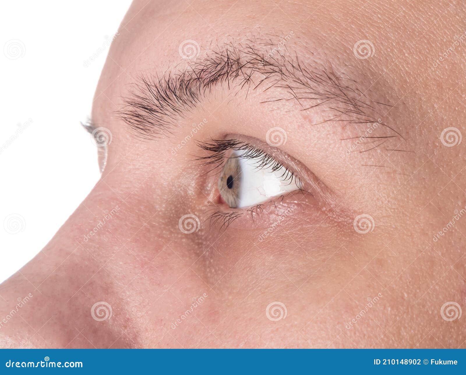 Eye of a Man with Keratoconus with Diseased Cornea Close-up Stock Photo ...