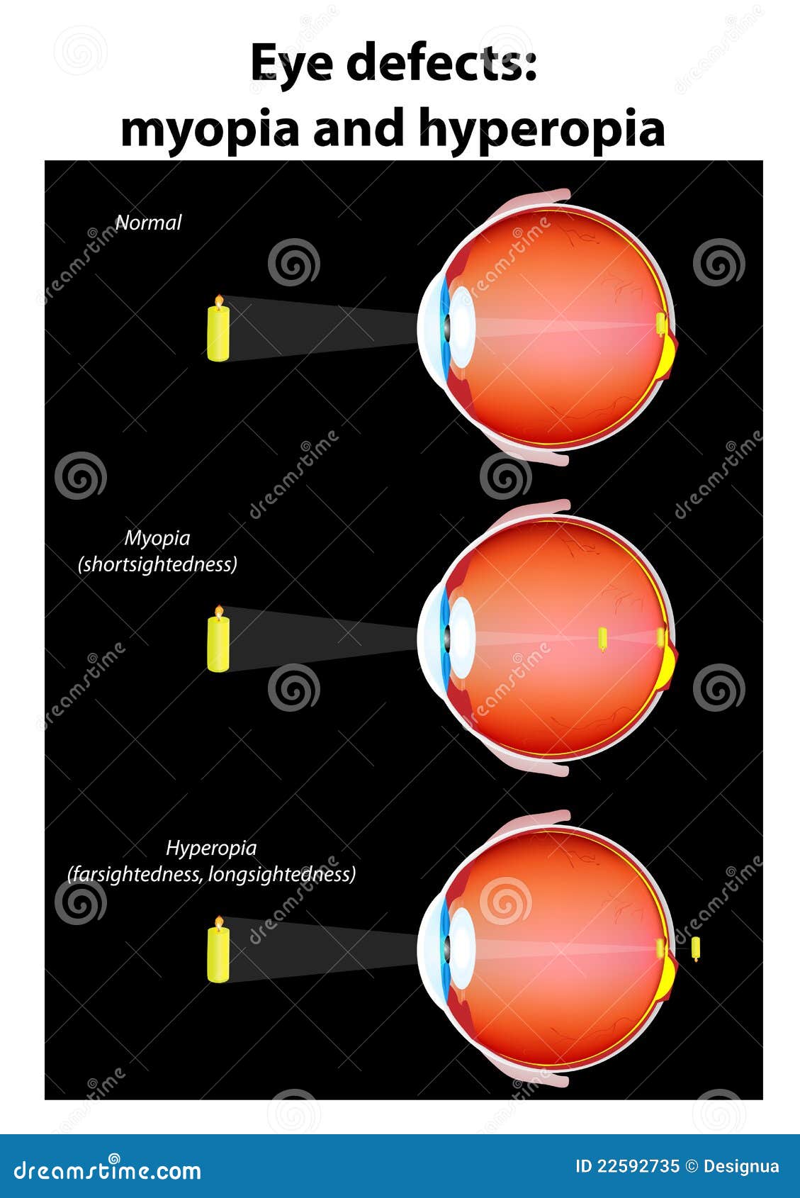 Eye Optical Defects : Myopia And Hyperopia. Vector | CartoonDealer.com ...
