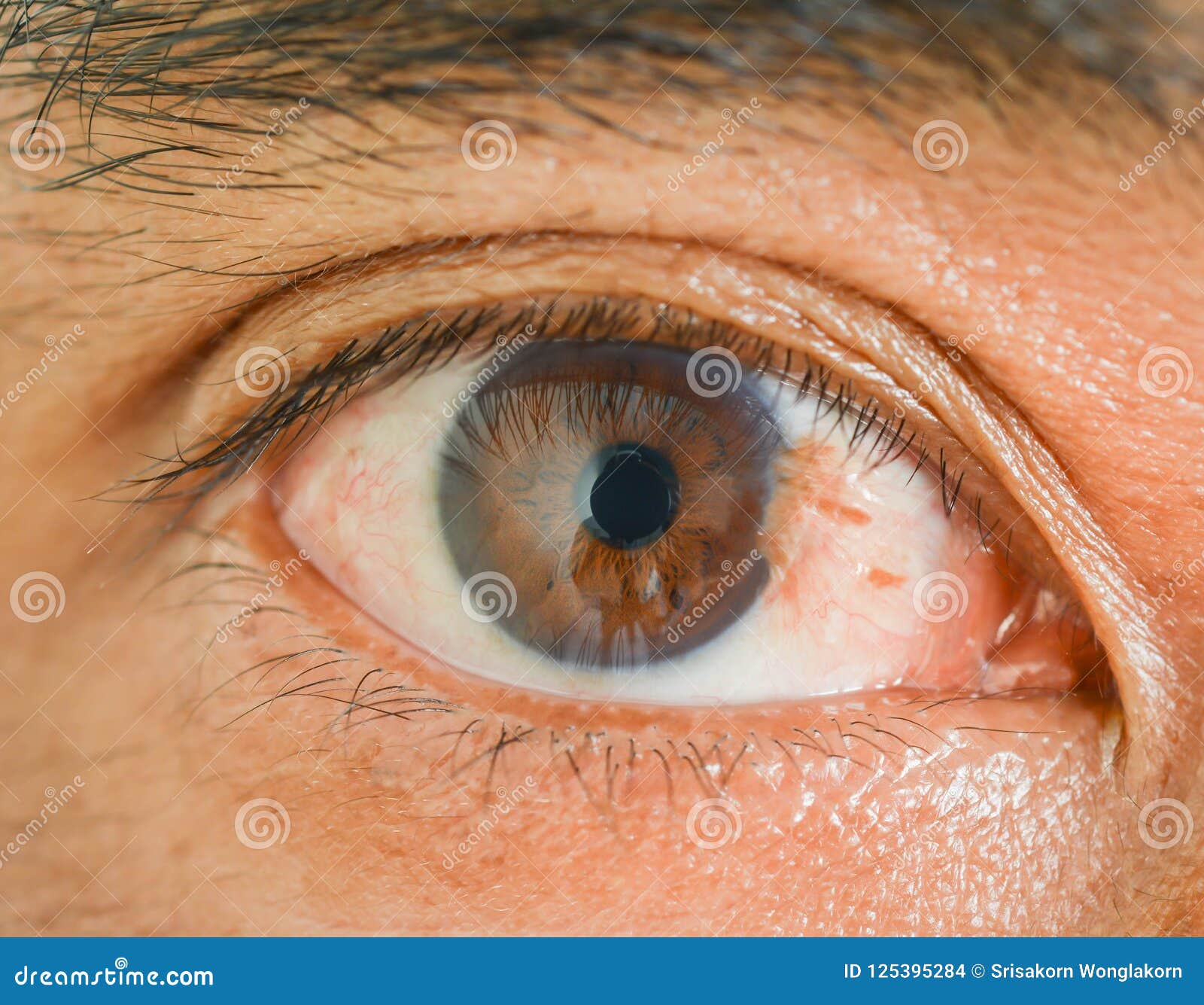 Close-up Of A Pterygium Or Surfer`s Eye Growing Onto The Cornea Eye ...