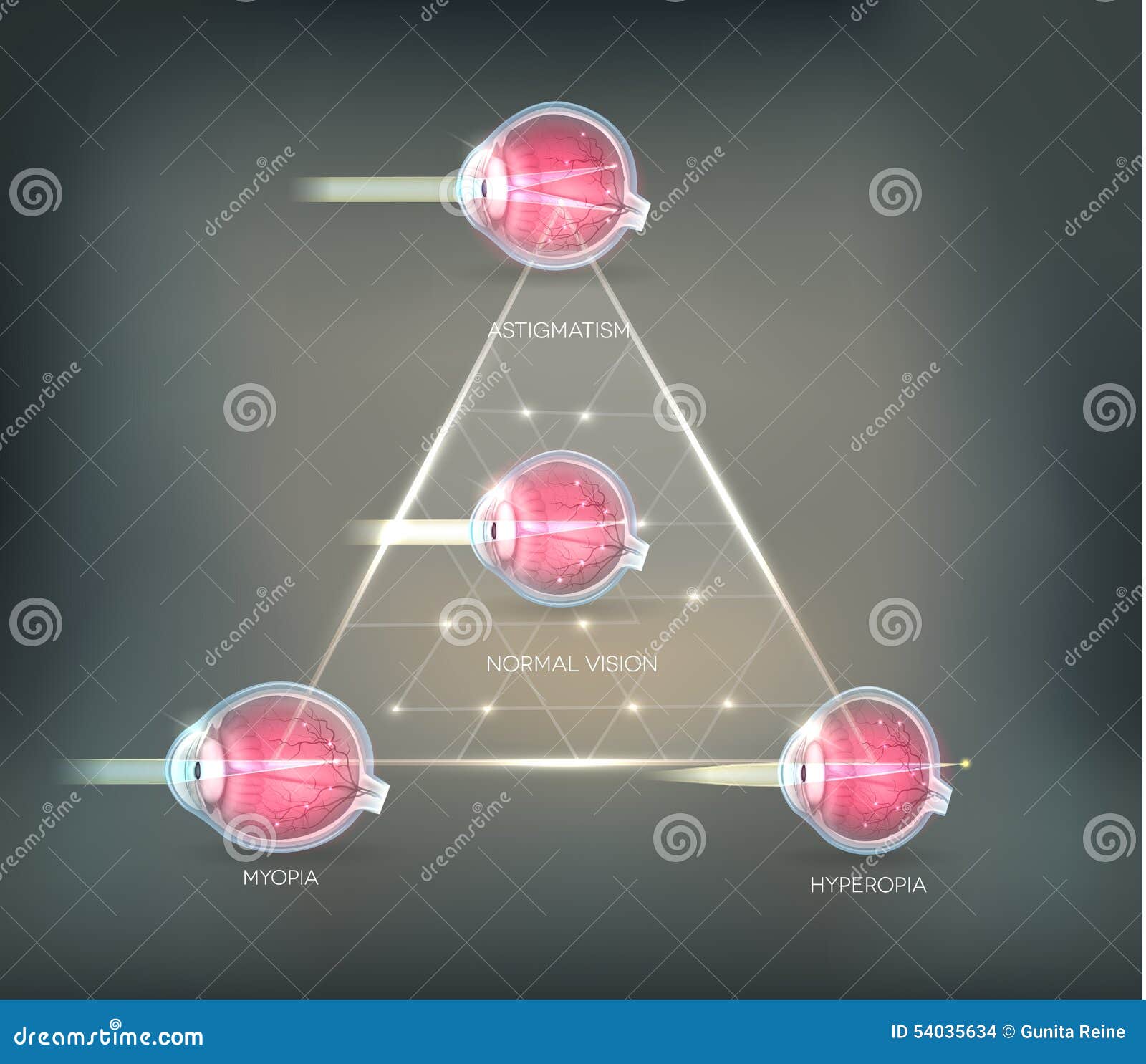 Eye vision disorders stock vector. Illustration of human - 54035634