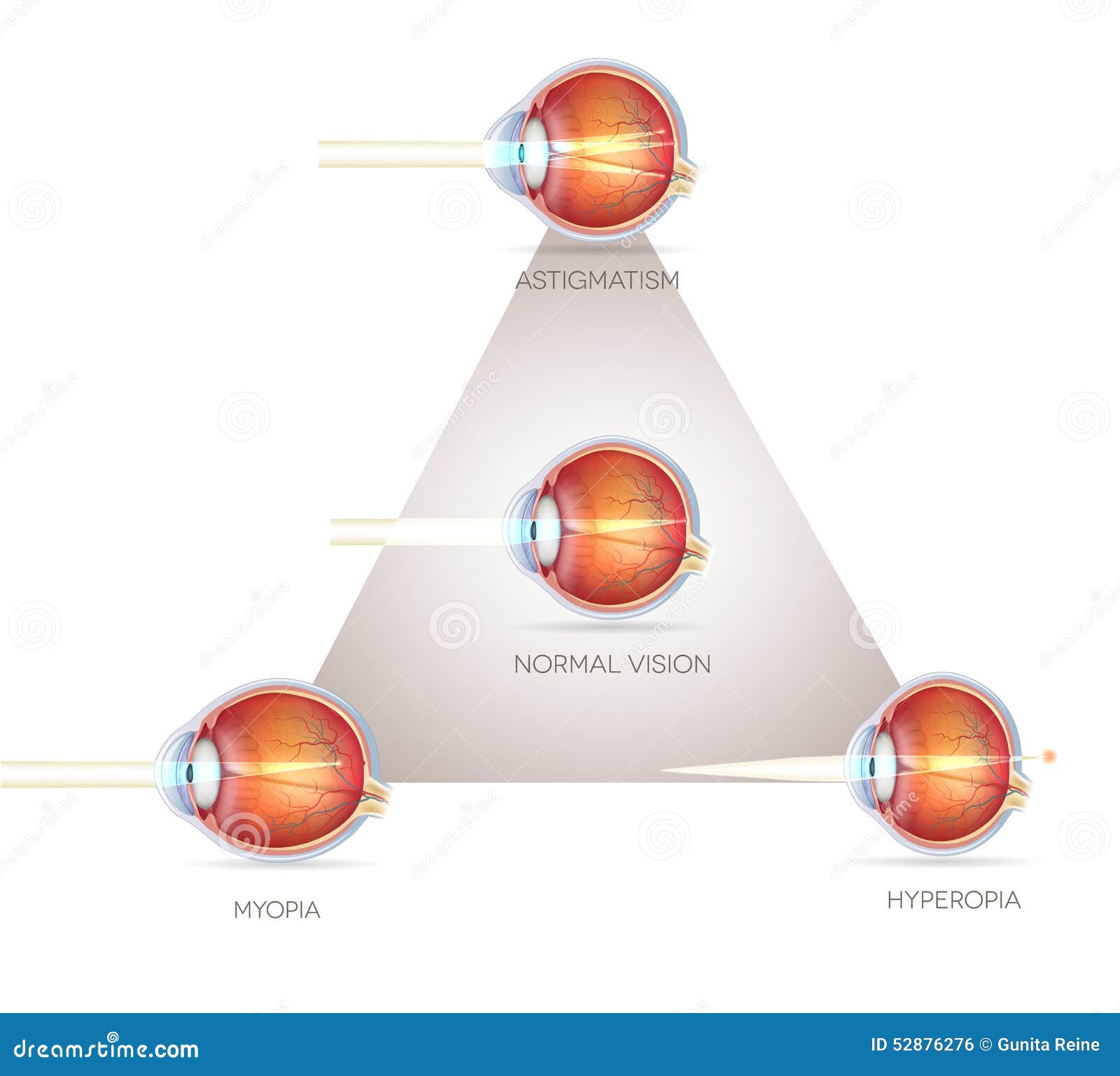 Eye vision triangle stock vector. Illustration of disease - 52876276