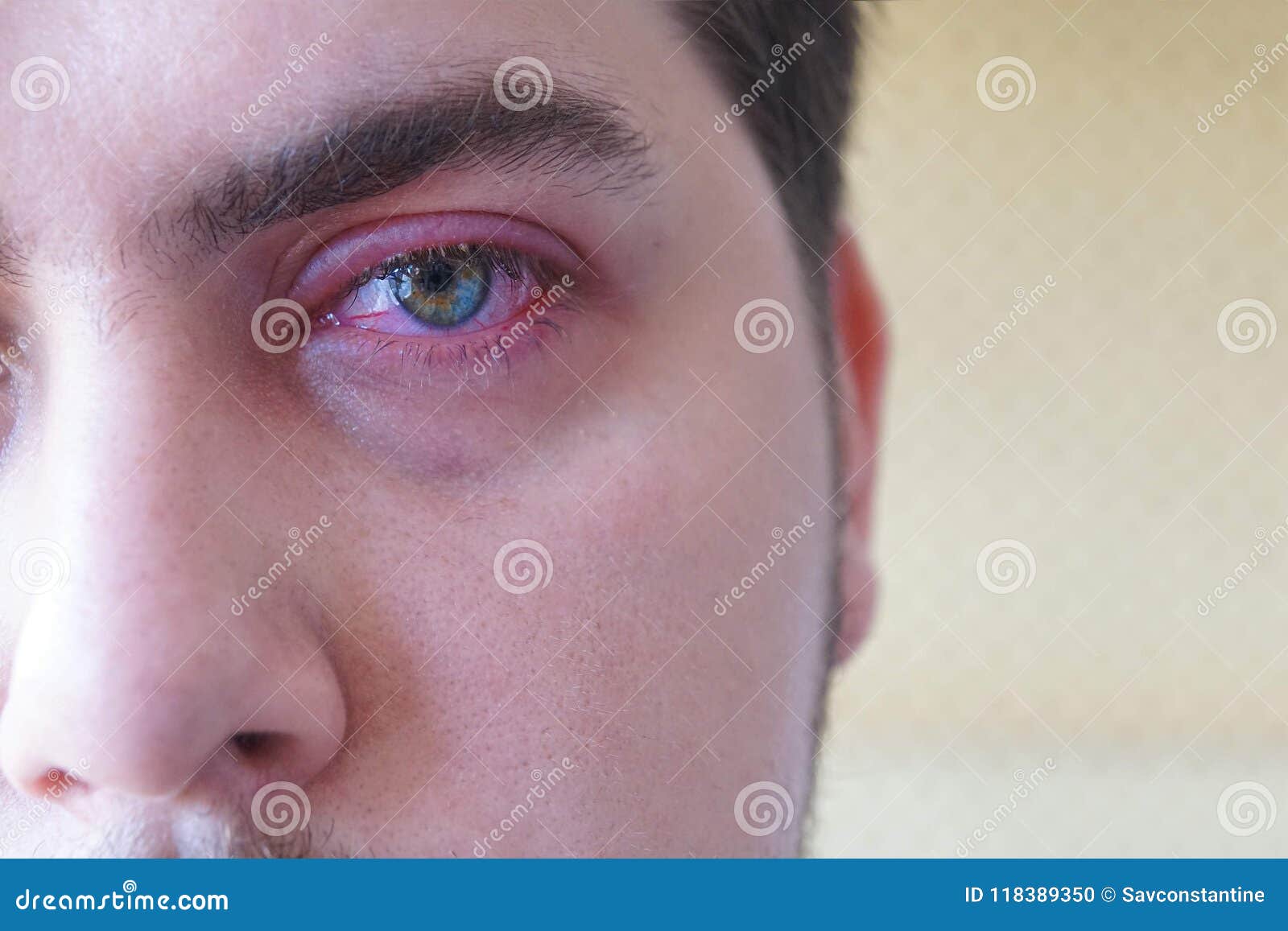 Eyelid Abscess Stock Photography | CartoonDealer.com #118389350