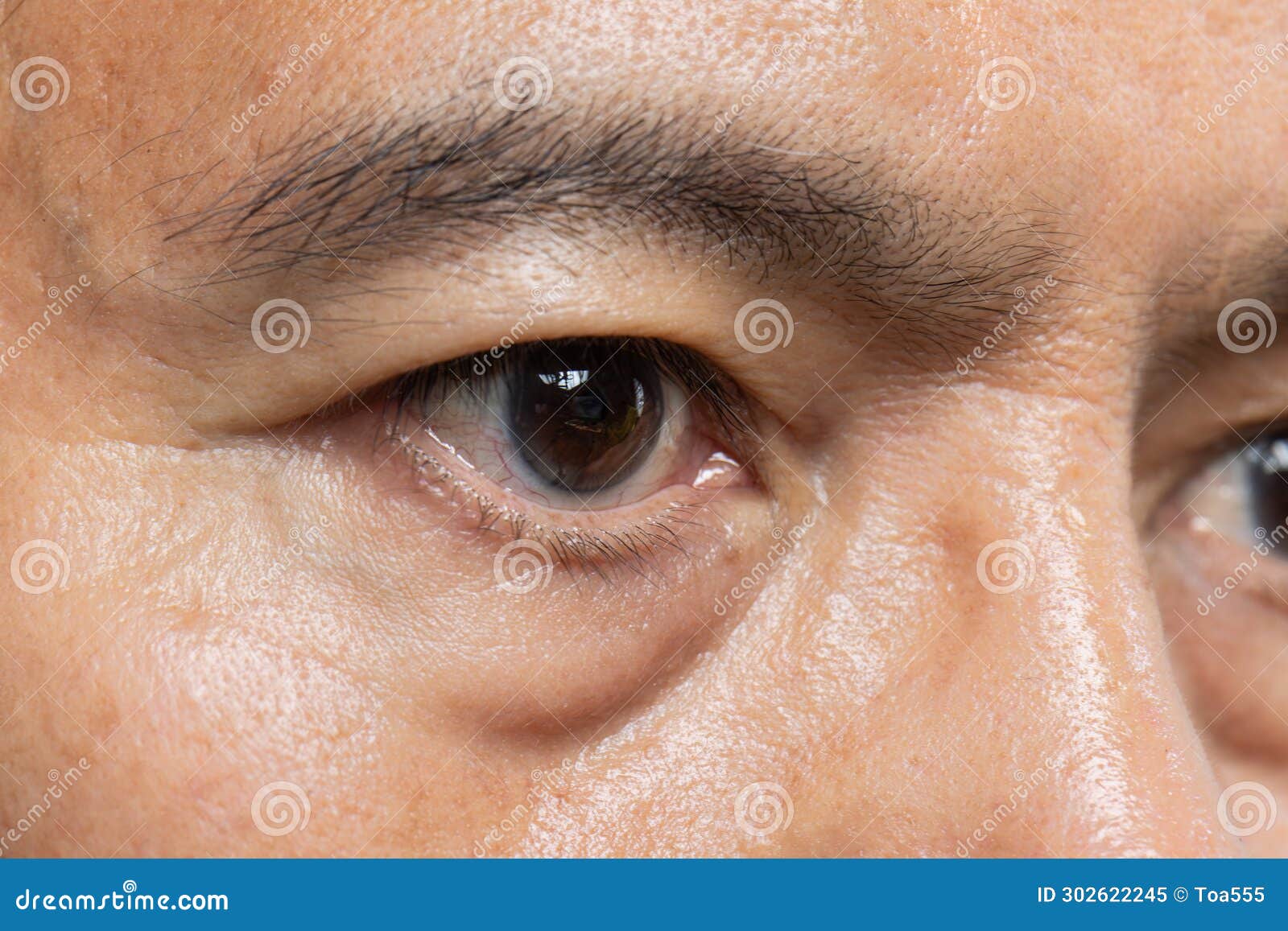Eyelid Spasm is Abnormal Contraction of the Eyelid Muscles Stock Image ...