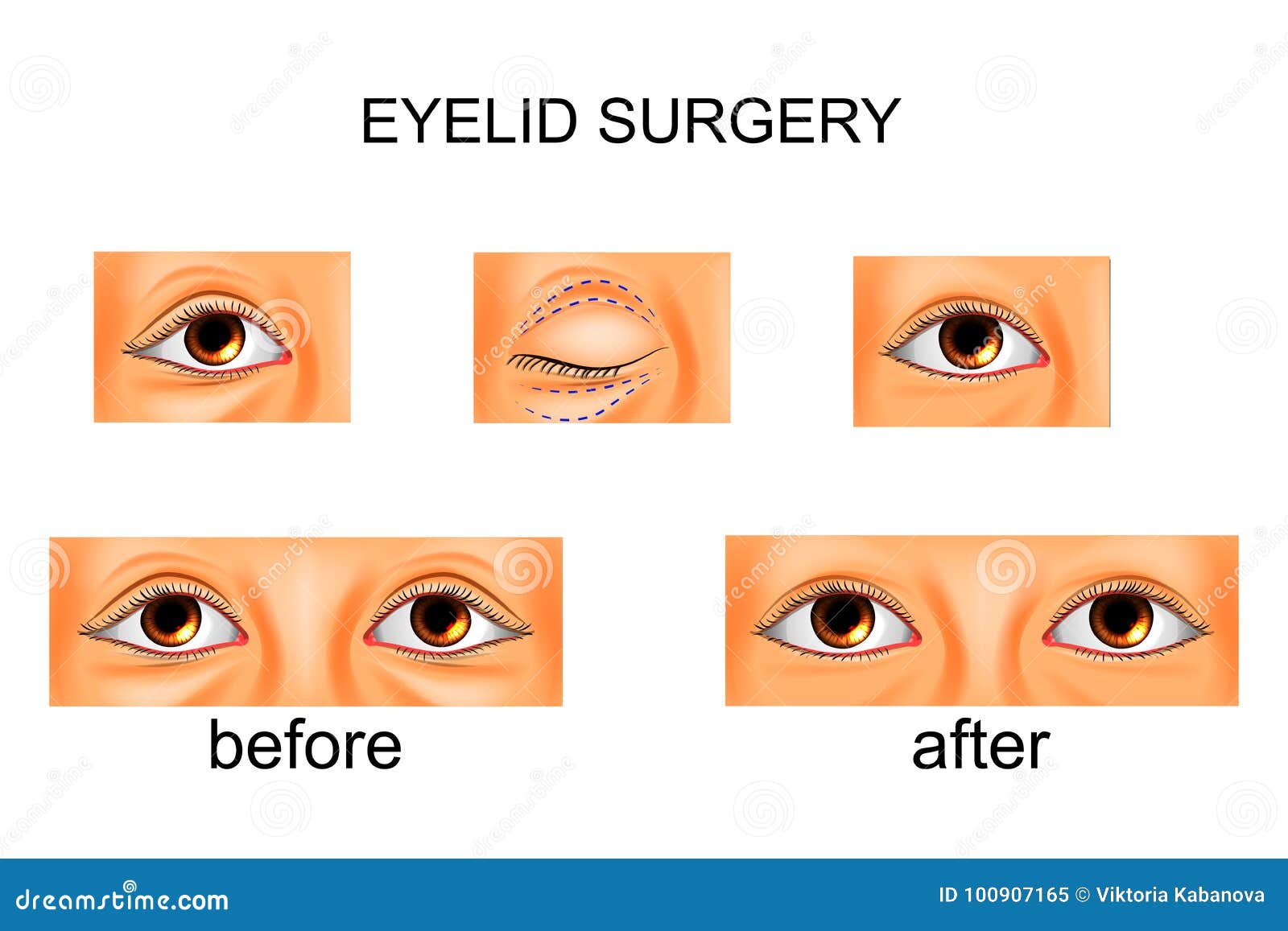 Eyelid Surgery, Plastic Surgery Cartoon Vector | CartoonDealer.com ...
