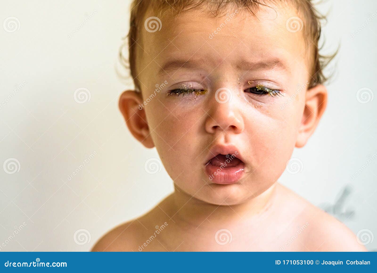 Eyes of a Baby with Bacterial Purulence Conjunctivitis Stock Photo ...