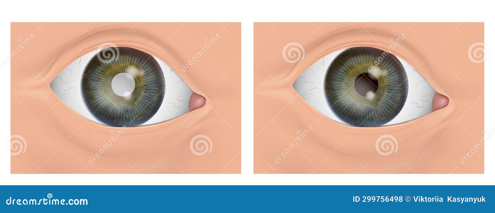 Eyes before and after Cataract Removal with and without Problem ...