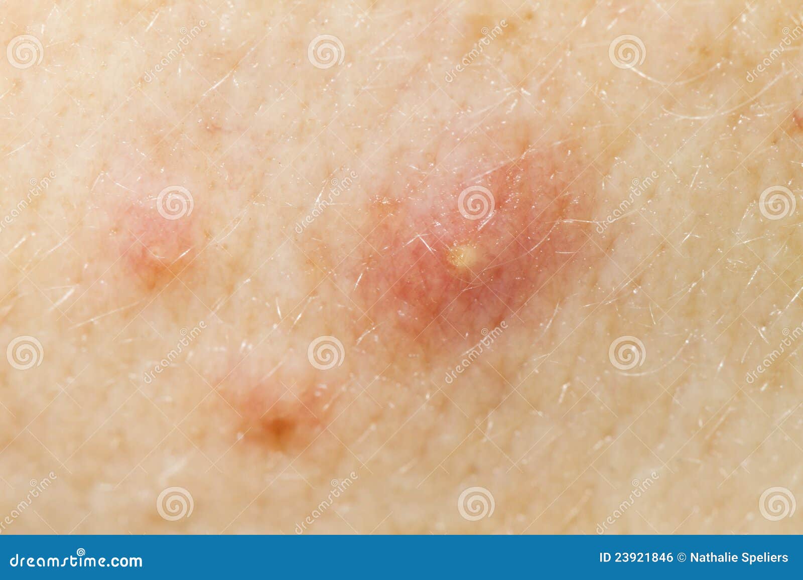 Face Acne Macro stock photo. Image of acne, face, macro - 23921846