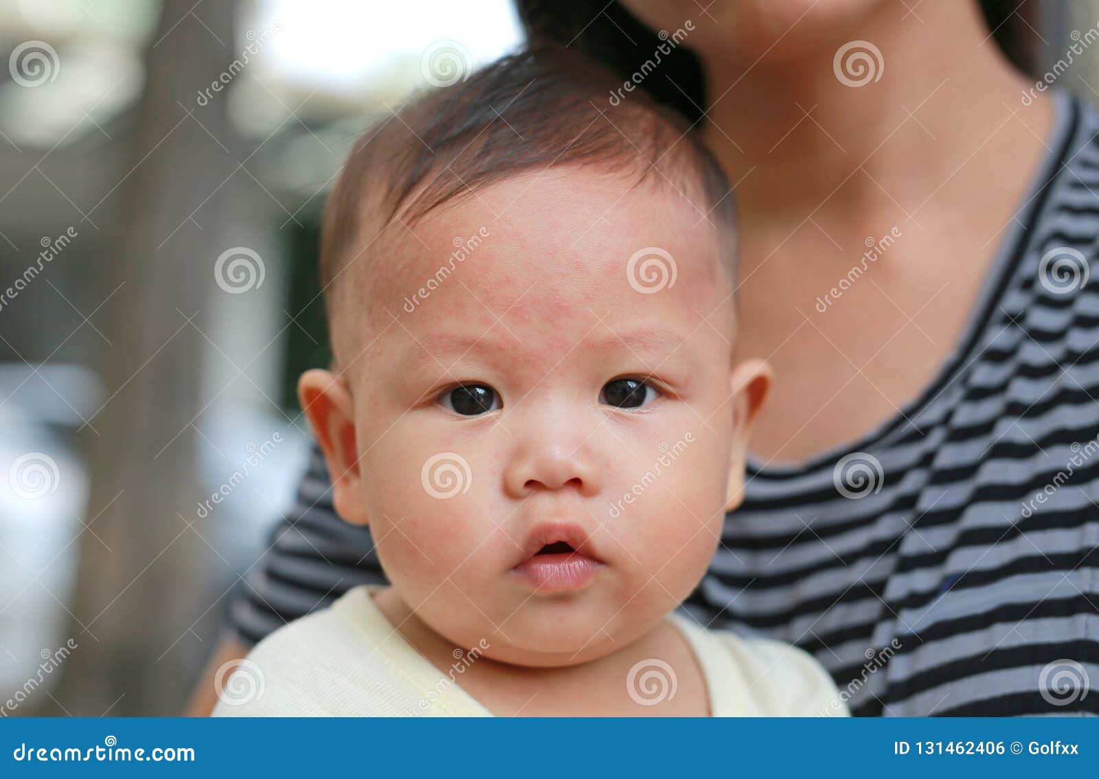 Face Baby Rashes, Dermatitis Stock Photo - Image of face, asian: 131462406