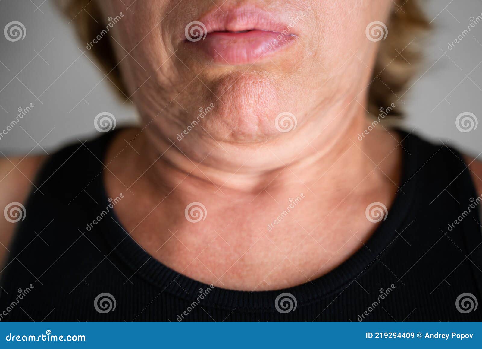 Face with Double Chin stock image. Image of surgery - 219294409