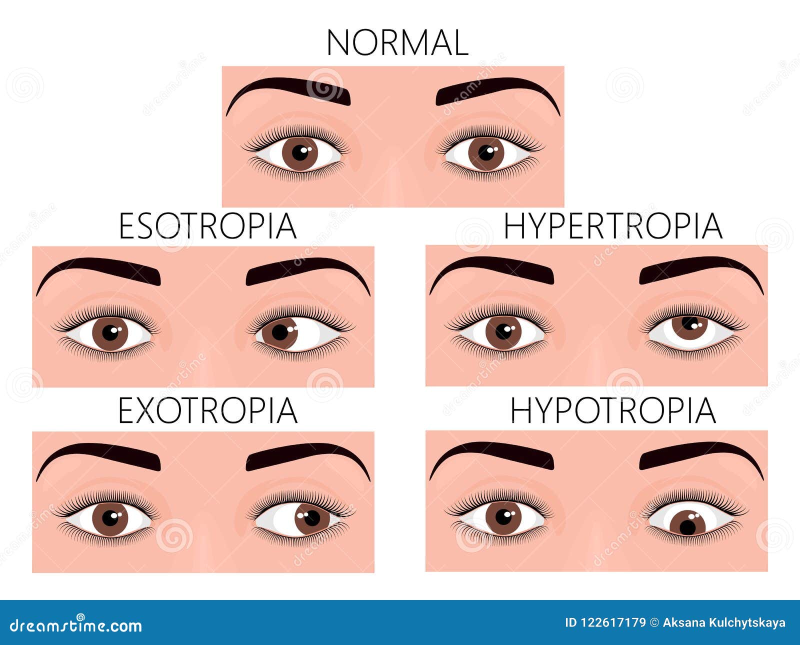 Crossed Eyes Types at Chris Henry blog Crossed Eyes Types at Chris Henry blog