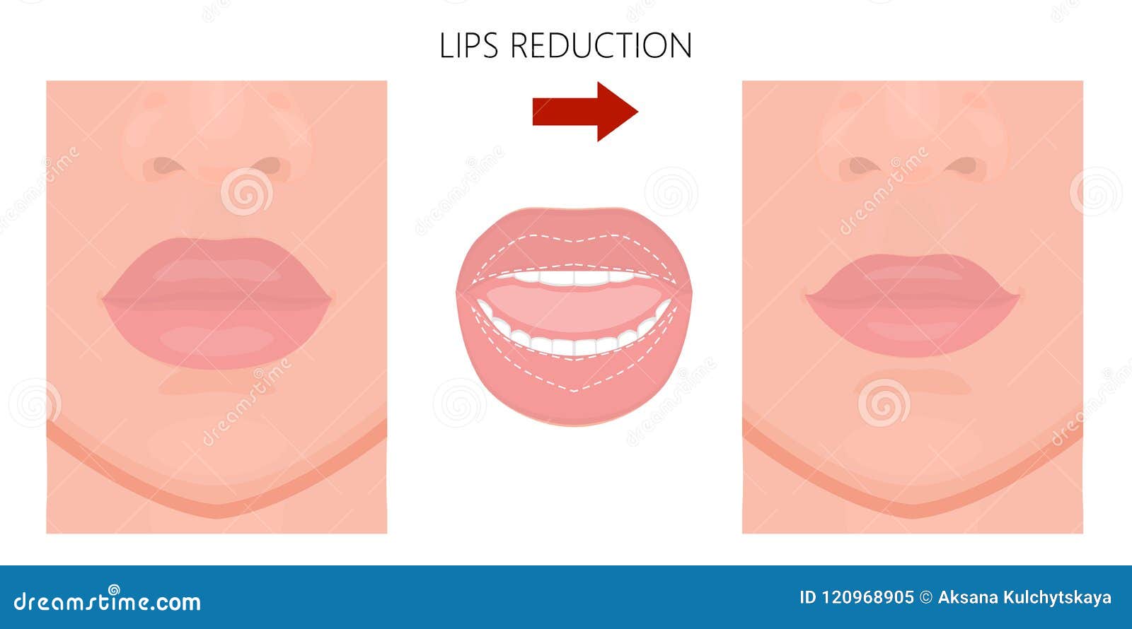 Face Front_Upper and Lower Lips Reduction Stock Vector - Illustration ...