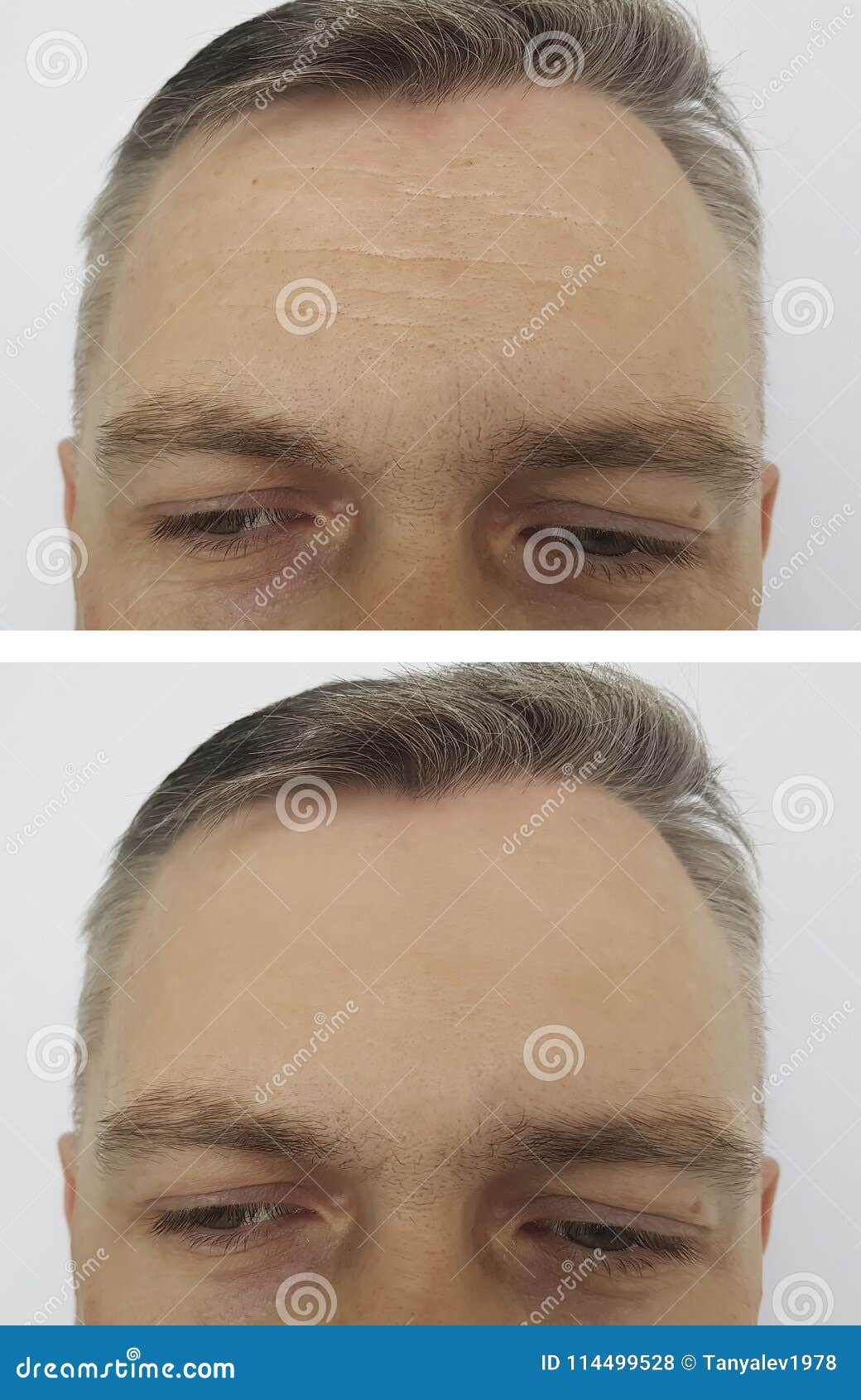 Face Man Wrinkles before and after Stock Photo - Image of natural ...