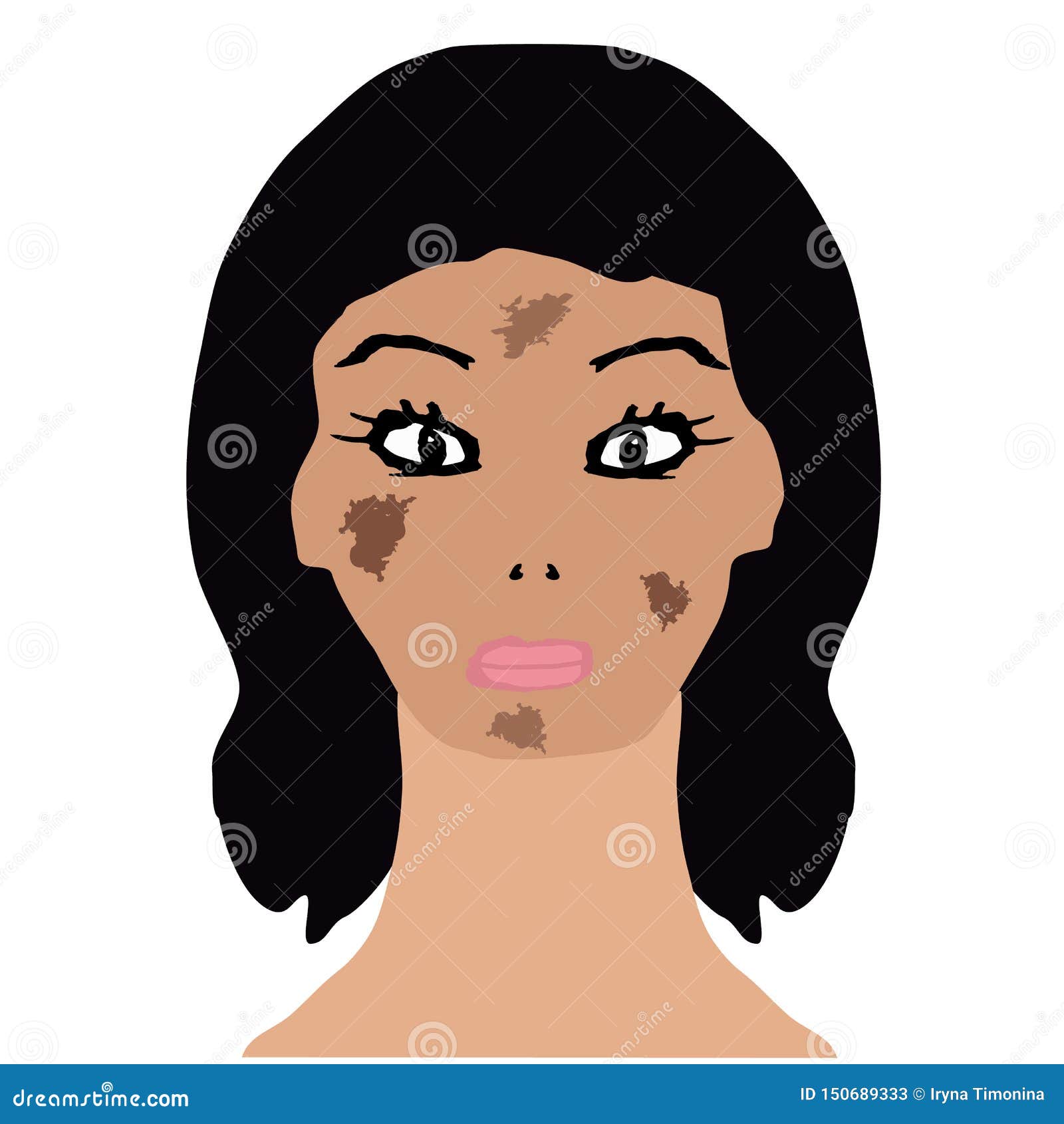 Face With Pigmentation. Brown Spots On The Skin. Infographics. Vector ...