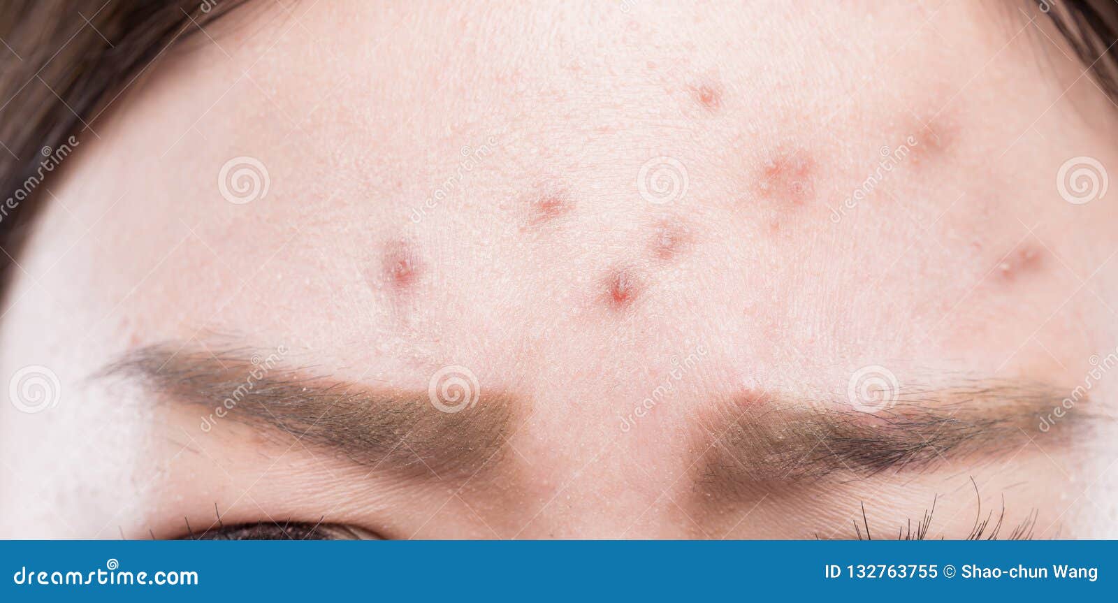 Facial acne on forehead stock image. Image of emotion - 132763755
