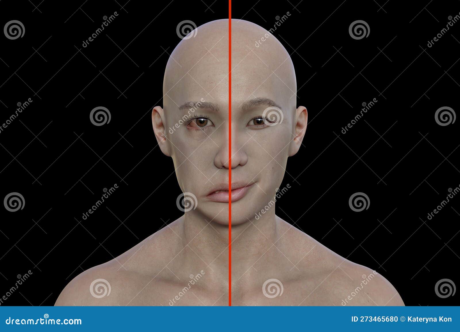 Facial Palsy in a Man, 3D Illustration Highlighting the Asymmetry and ... Facial Palsy in a Man, 3D Illustration Highlighting the Asymmetry and ...